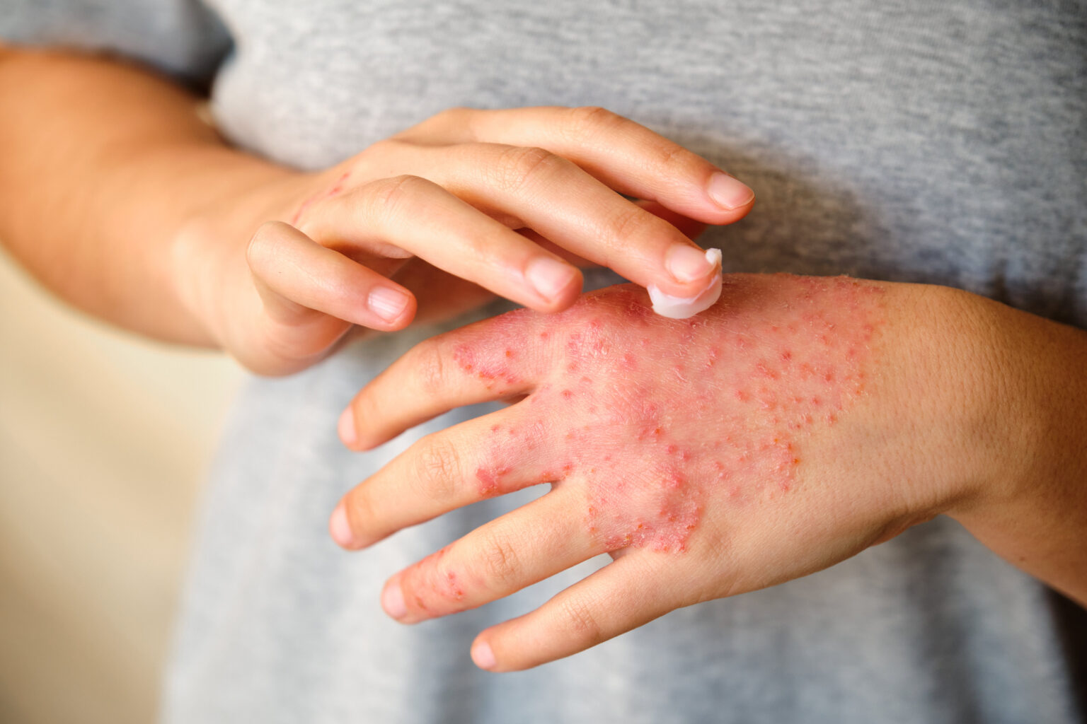 Managing Severe Eczema with Biologic Treatments | Allergy, Asthma, and ...